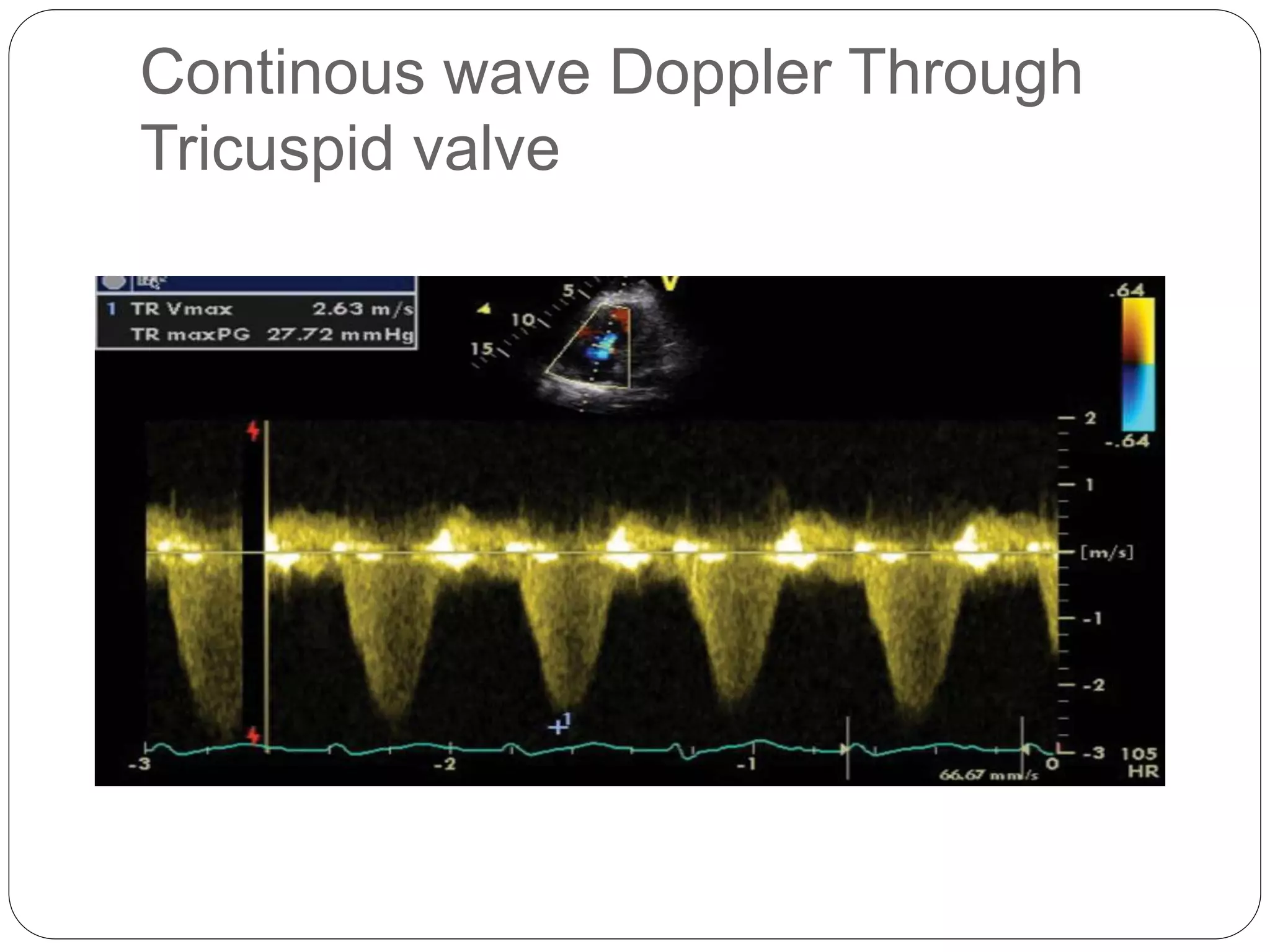 Basics of echo Cardiac Structure, Chamber quantifications & Artifacts.pptx