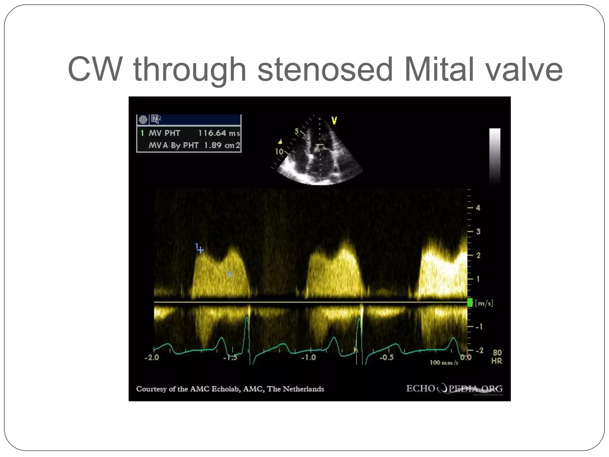Basics of echo Cardiac Structure, Chamber quantifications & Artifacts.pptx