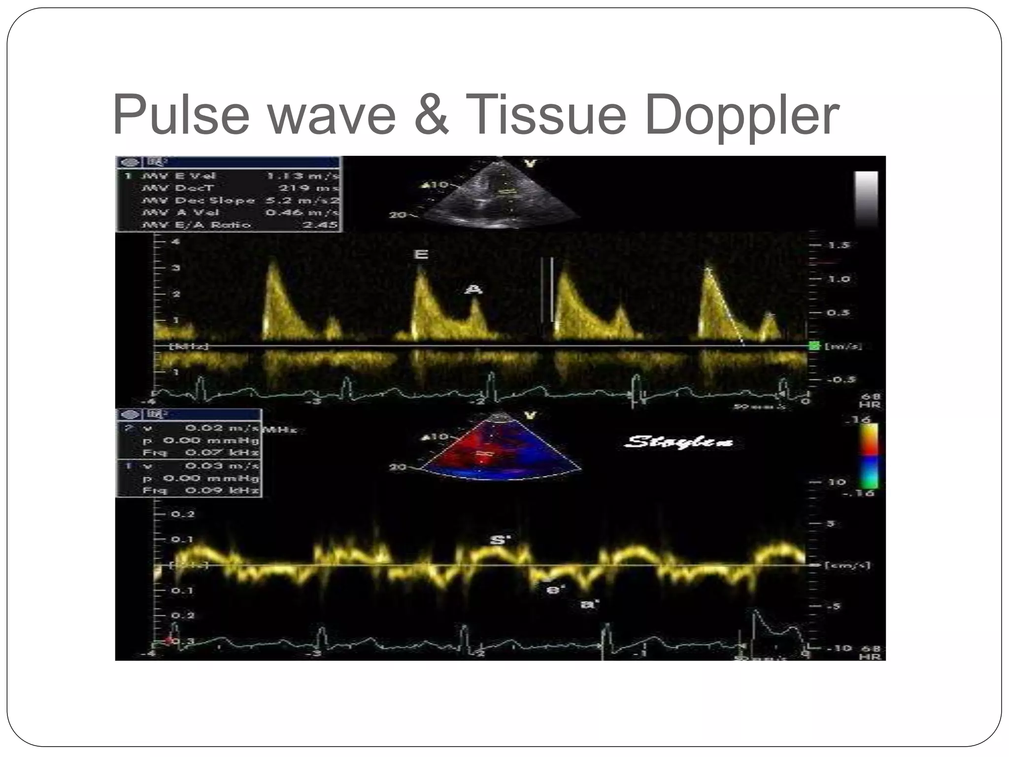 Basics of echo Cardiac Structure, Chamber quantifications & Artifacts.pptx