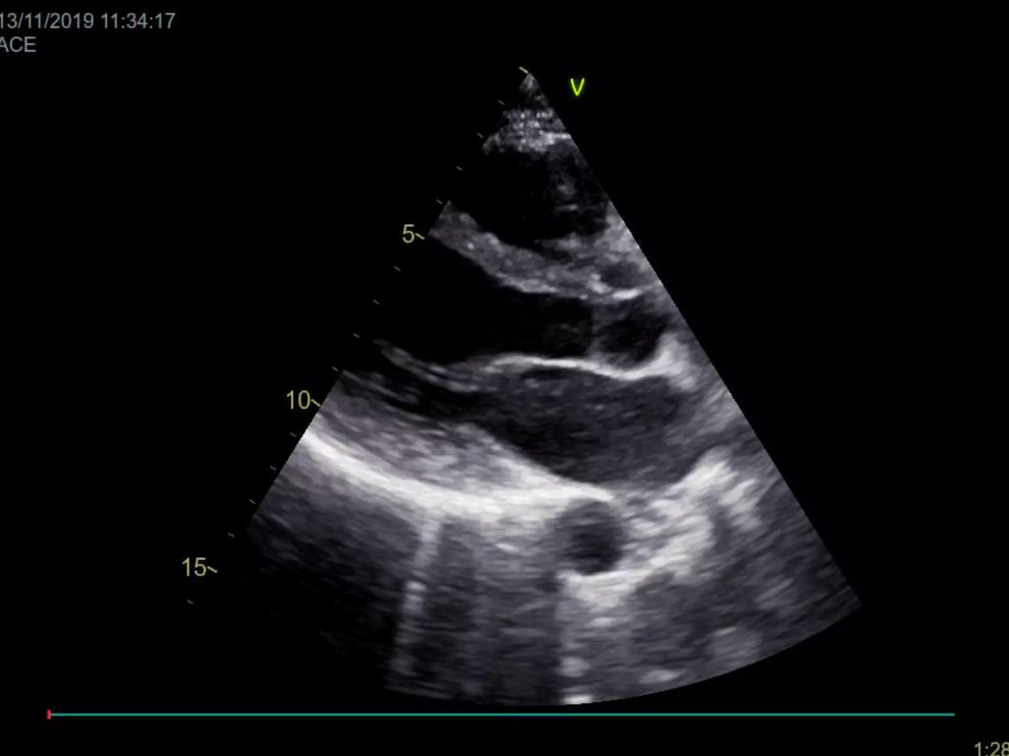 Basics of echo Cardiac Structure, Chamber quantifications & Artifacts.pptx