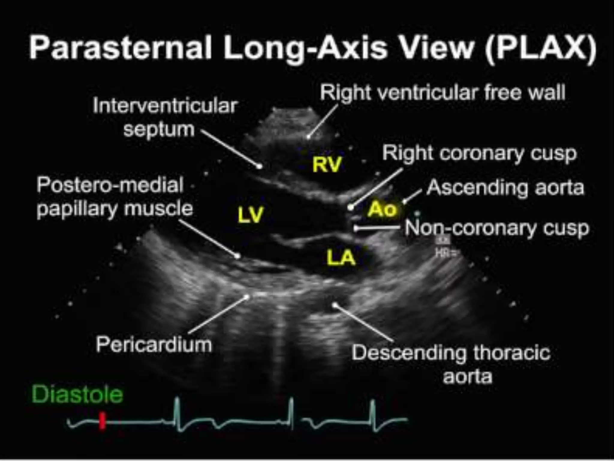 Basics of echo Cardiac Structure, Chamber quantifications & Artifacts.pptx