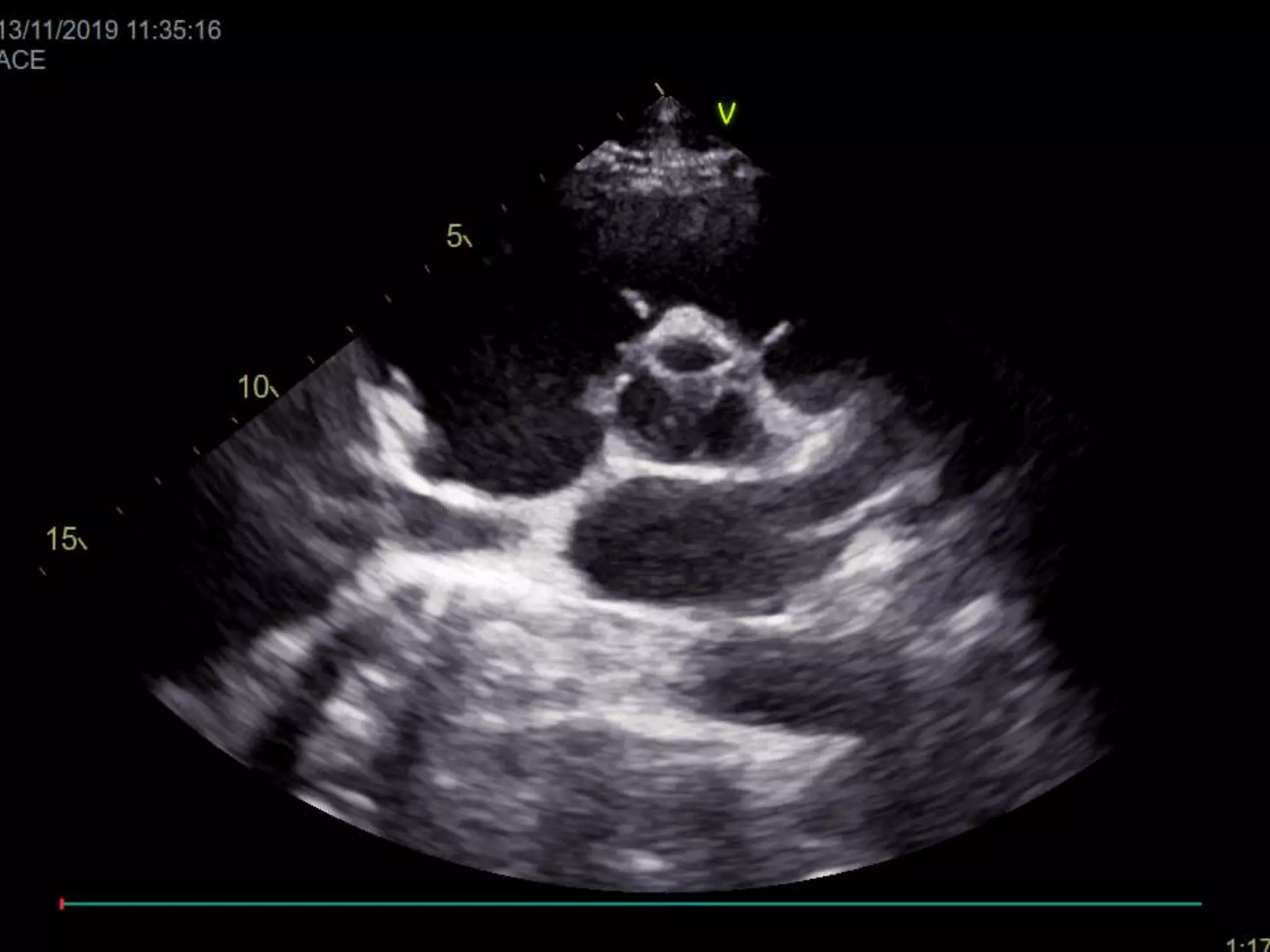Basics of echo Cardiac Structure, Chamber quantifications & Artifacts.pptx