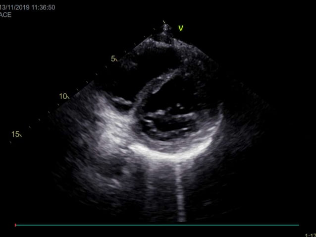Basics of echo Cardiac Structure, Chamber quantifications & Artifacts.pptx | Digital Audio ...
