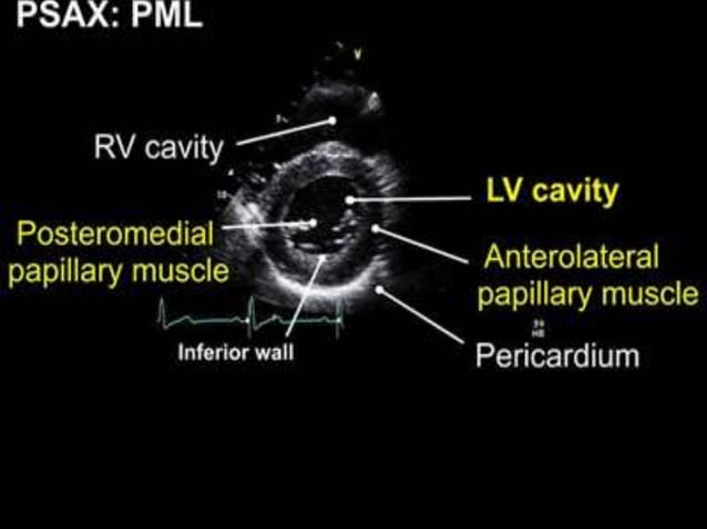 Basics of echo Cardiac Structure, Chamber quantifications & Artifacts.pptx | Digital Audio ...