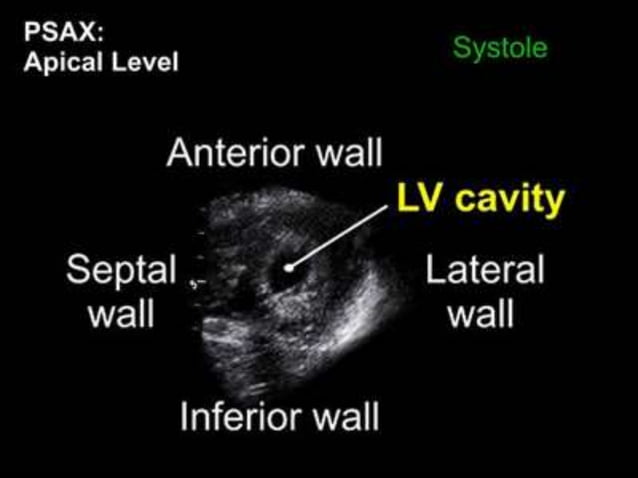 Basics of echo Cardiac Structure, Chamber quantifications & Artifacts.pptx | Digital Audio ...