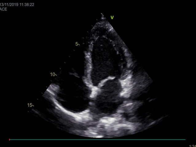 Basics of echo Cardiac Structure, Chamber quantifications & Artifacts.pptx | Digital Audio ...