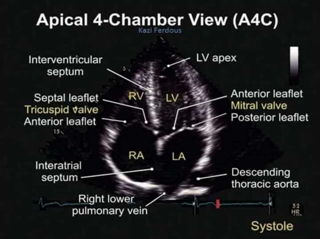 Basics of echo Cardiac Structure, Chamber quantifications & Artifacts.pptx | Digital Audio ...