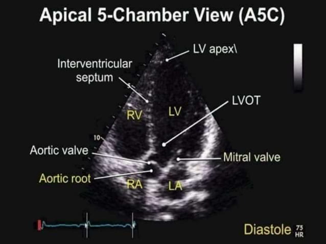 Basics of echo Cardiac Structure, Chamber quantifications & Artifacts.pptx | Digital Audio ...