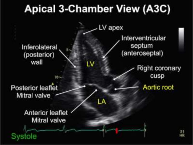 Basics of echo Cardiac Structure, Chamber quantifications & Artifacts.pptx | Digital Audio ...