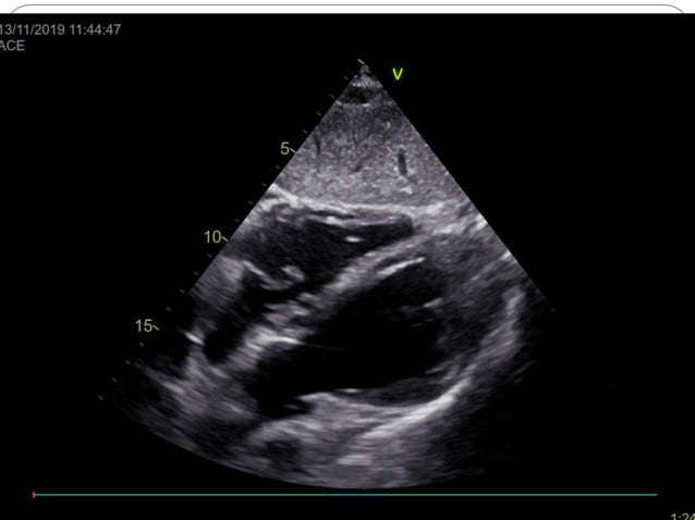 Basics of echo Cardiac Structure, Chamber quantifications & Artifacts.pptx | Digital Audio ...