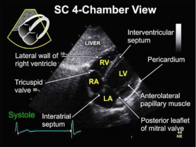 Basics of echo Cardiac Structure, Chamber quantifications & Artifacts.pptx | Digital Audio ...