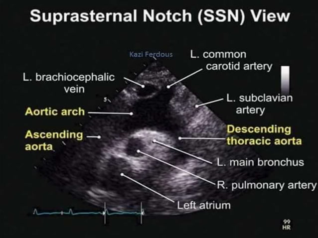 Basics of echo Cardiac Structure, Chamber quantifications & Artifacts.pptx | Digital Audio ...