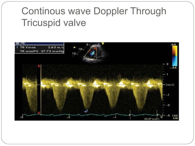 Basics of echo Cardiac Structure, Chamber quantifications & Artifacts.pptx | Digital Audio ...