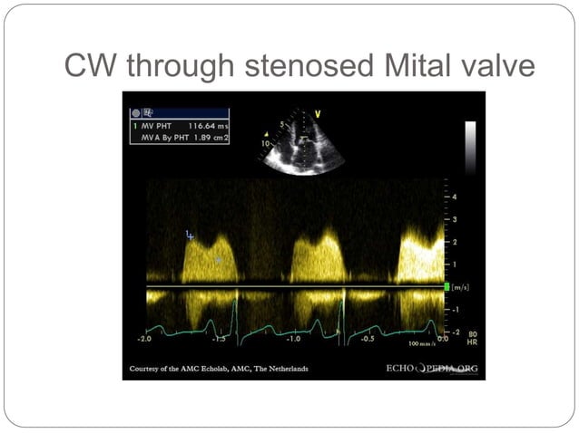 Basics of echo Cardiac Structure, Chamber quantifications & Artifacts.pptx | Digital Audio ...