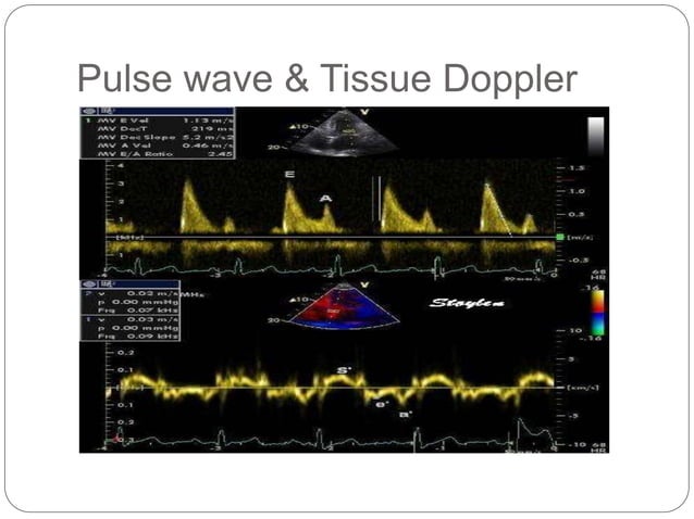 Basics of echo Cardiac Structure, Chamber quantifications & Artifacts.pptx | Digital Audio ...