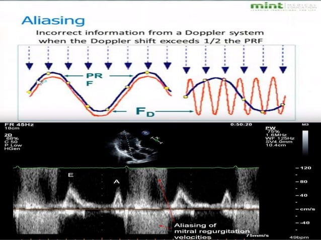 Basics of echo Cardiac Structure, Chamber quantifications & Artifacts.pptx | Digital Audio ...
