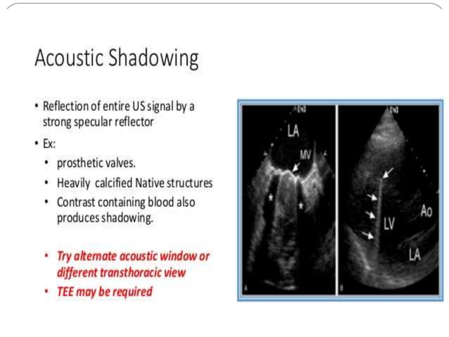 Basics of echo Cardiac Structure, Chamber quantifications & Artifacts.pptx | Digital Audio ...