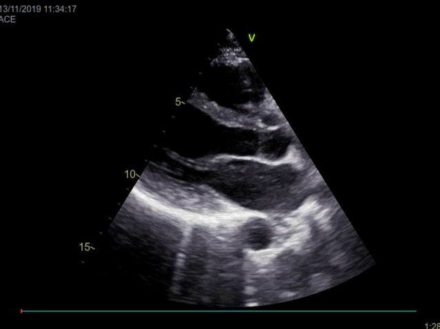 Basics of echo Cardiac Structure, Chamber quantifications & Artifacts.pptx | Digital Audio ...