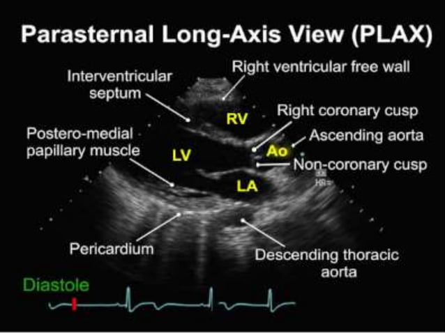 Basics of echo Cardiac Structure, Chamber quantifications & Artifacts.pptx | Digital Audio ...