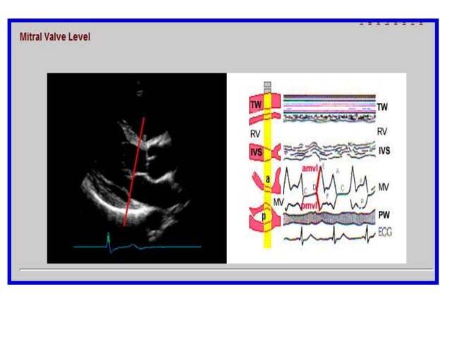 Basics of echo & principles of doppler echocardiography | PPTX | Heart ...