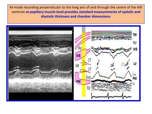 Basics of echo & principles of doppler echocardiography | PPTX | Heart ...