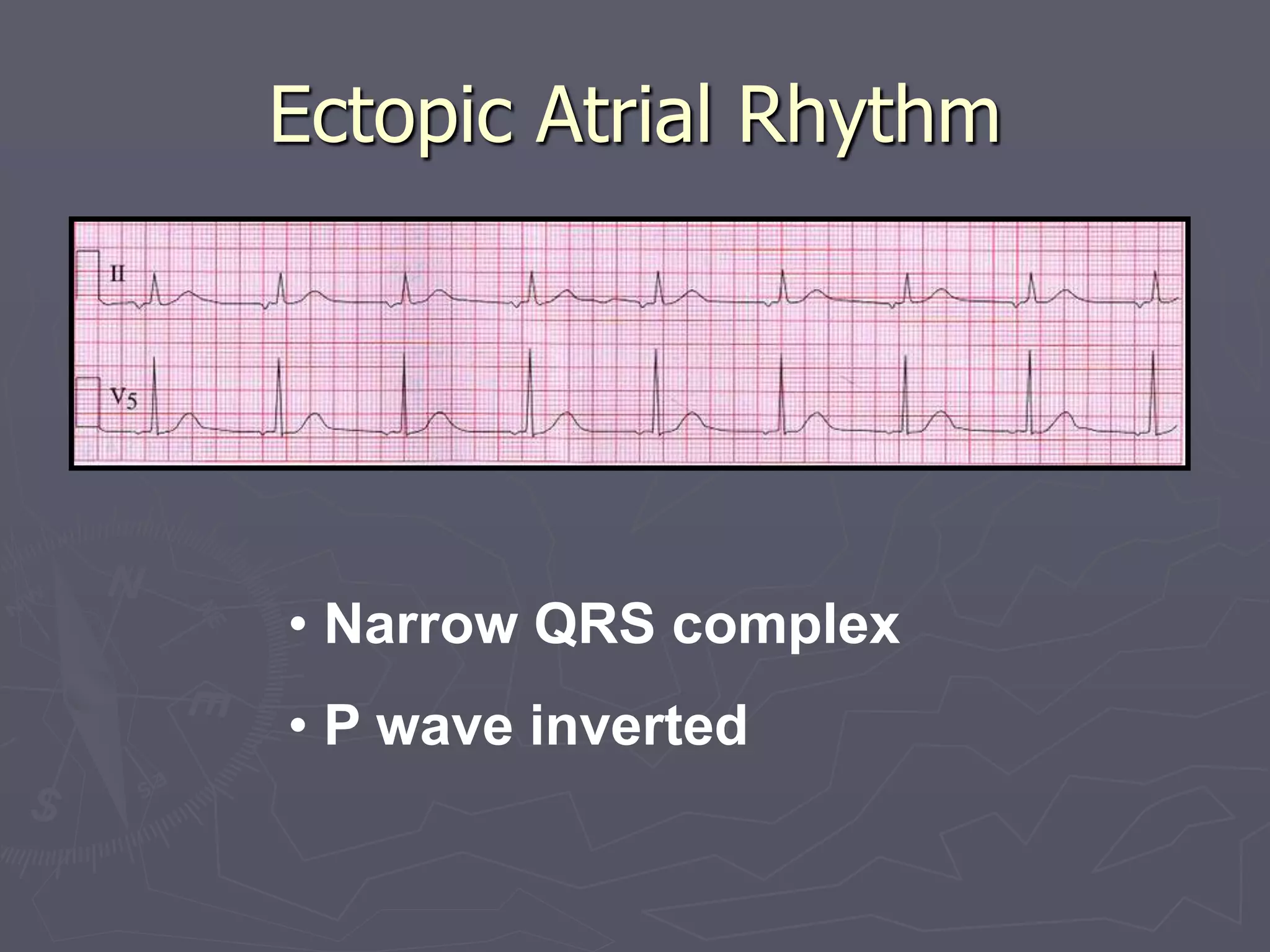Basics of EKG Interpretation.ppt