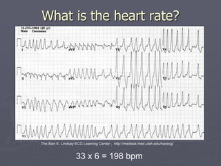Basics of EKG Interpretation.ppt