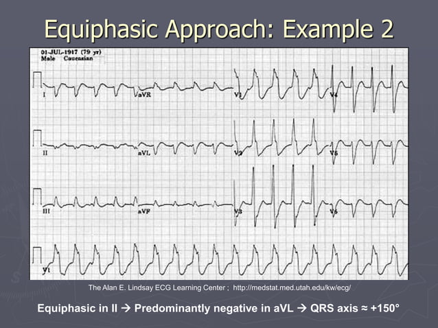 Basics of EKG Interpretation.ppt