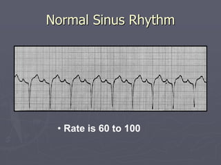 Basics of EKG Interpretation.ppt