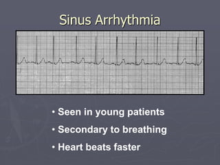 Basics of EKG Interpretation.ppt