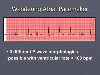 Basics of EKG Interpretation.ppt