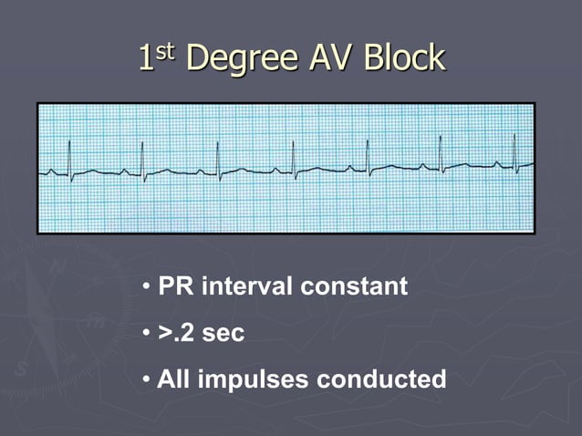 Basics of EKG Interpretation.ppt