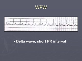 Basics of EKG Interpretation.ppt