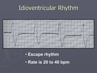Basics of EKG Interpretation.ppt