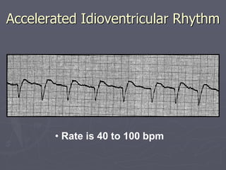 Basics of EKG Interpretation.ppt