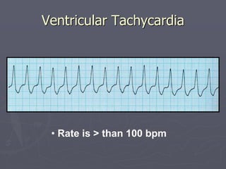 Basics of EKG Interpretation.ppt
