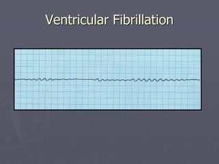 Basics of EKG Interpretation.ppt