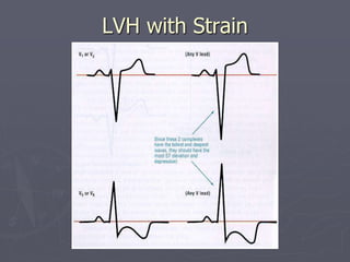 Basics of EKG Interpretation.ppt