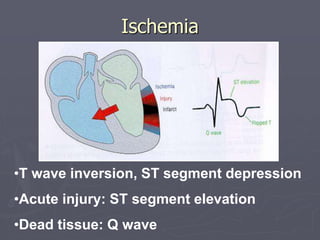 Basics of EKG Interpretation.ppt