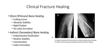 Basics of fracture healing of bones.pptx