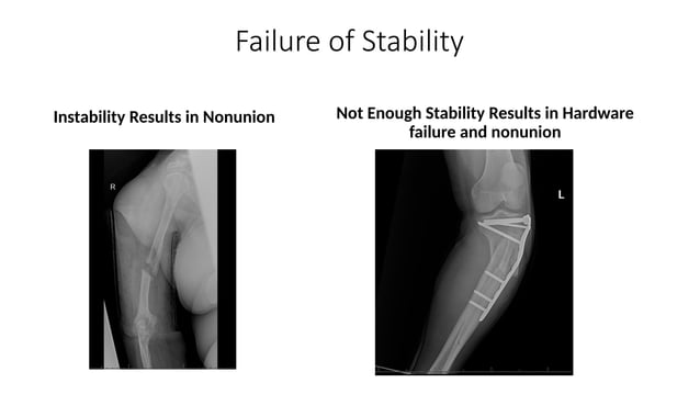 Basics of fracture healing of bones.pptx