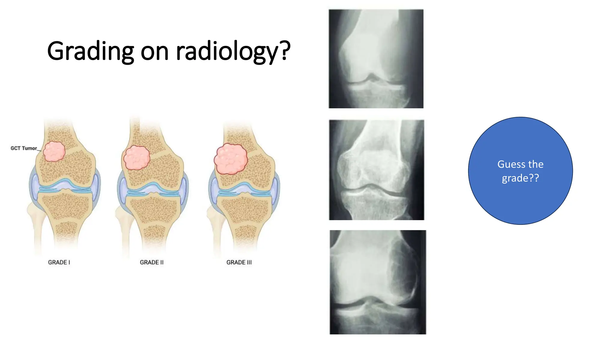 Basics of Giant Cell Tumor of bone (GCTB) | PPTX