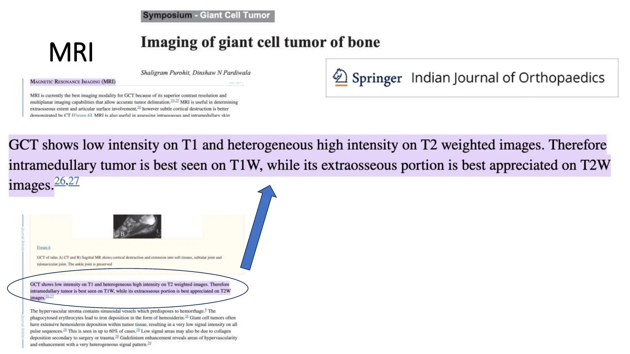 Basics of Giant Cell Tumor of bone (GCTB) | PPTX