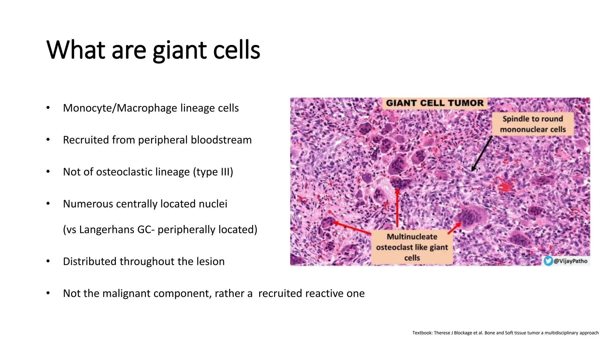 Basics of Giant Cell Tumor of bone (GCTB) | PPTX