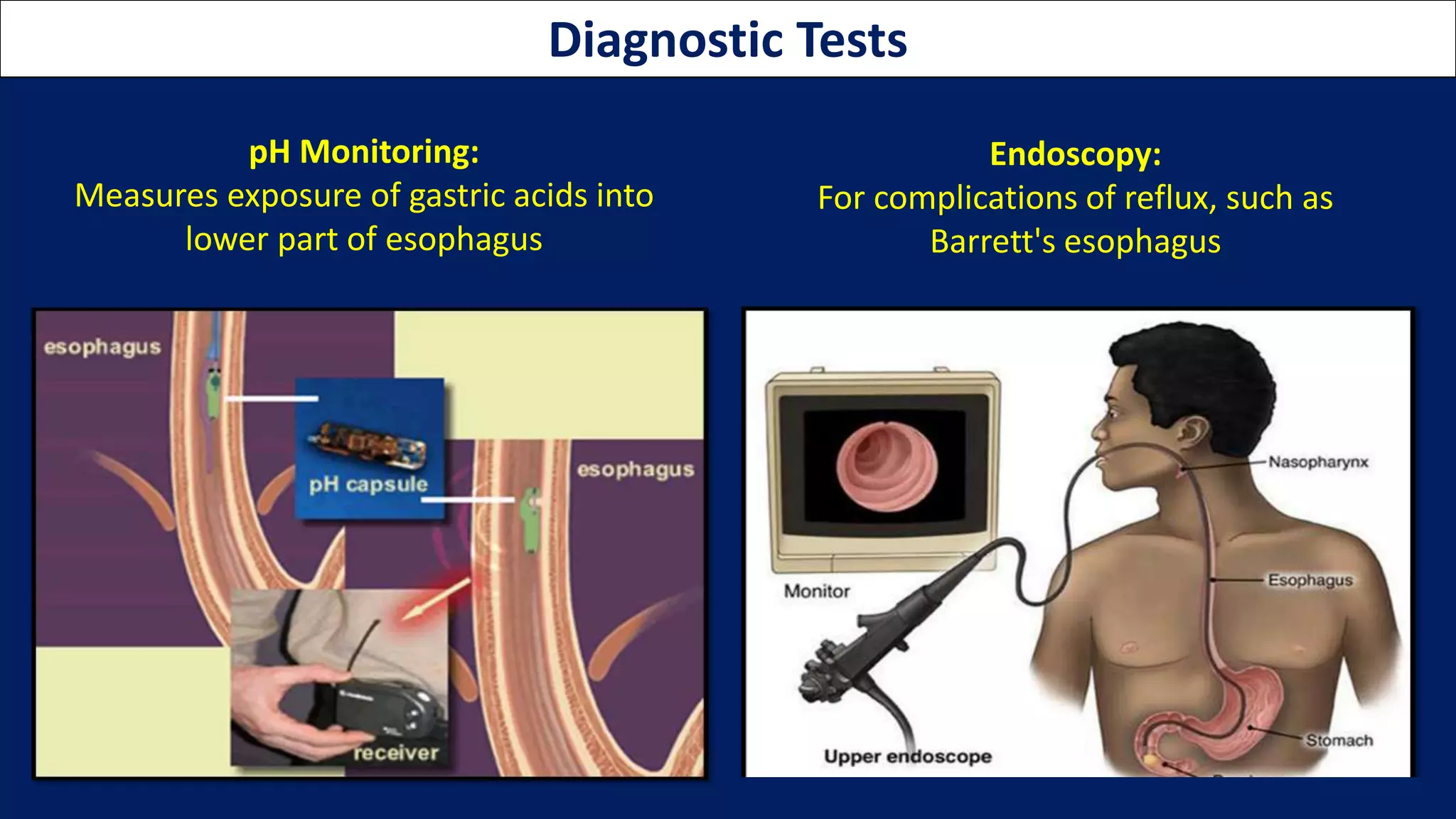 Basics of GERD, peptic Ulcer & Gastroparesis | PPT