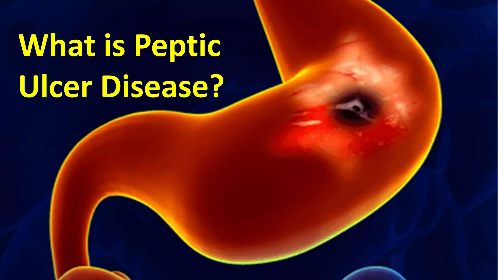 Basics of GERD, peptic Ulcer & Gastroparesis | PPTX