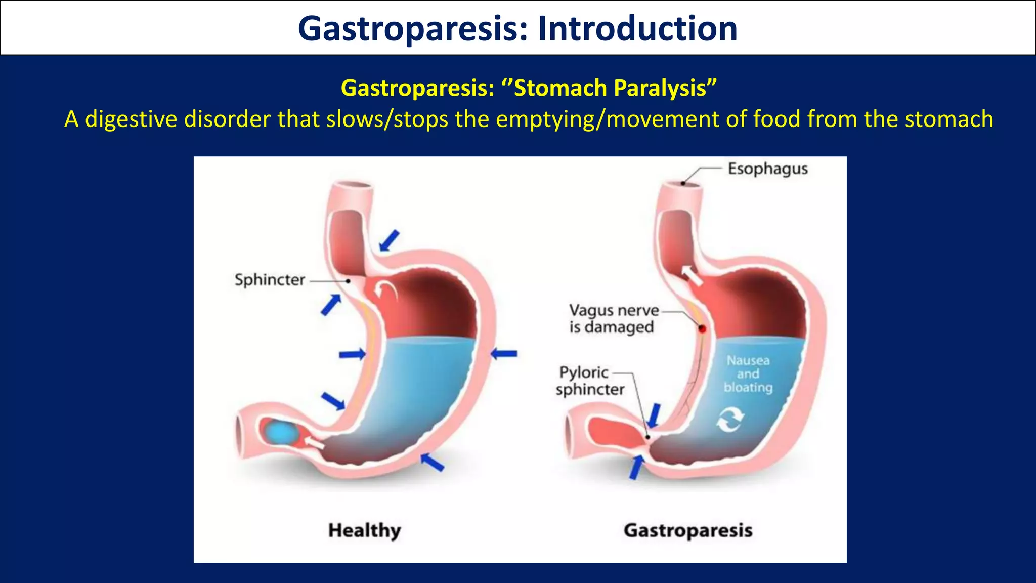 Basics of GERD, peptic Ulcer & Gastroparesis | PPT