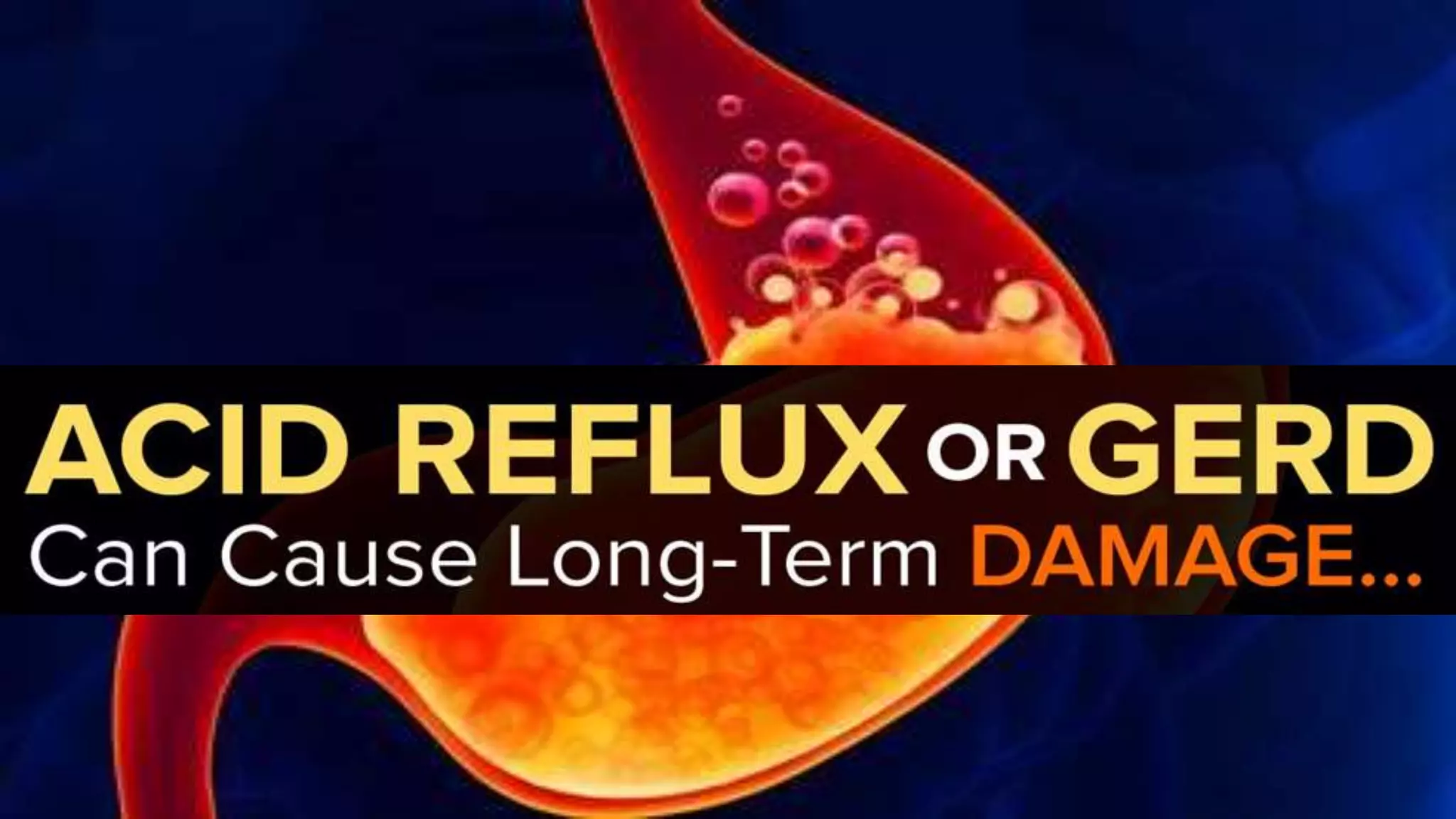 Basics of GERD, peptic Ulcer & Gastroparesis | PPTX