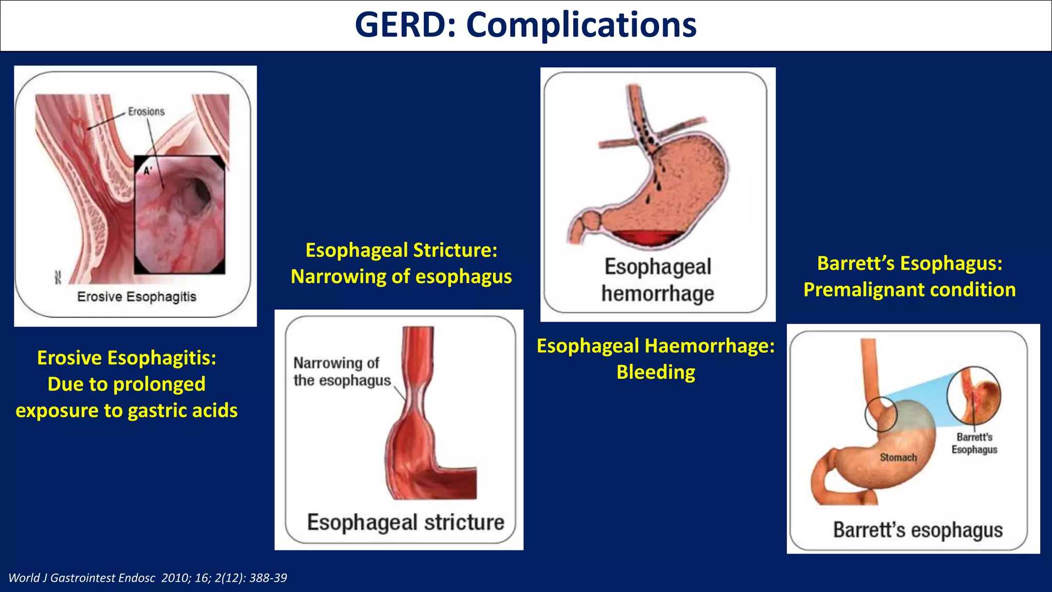 Basics of GERD, peptic Ulcer & Gastroparesis | PPTX