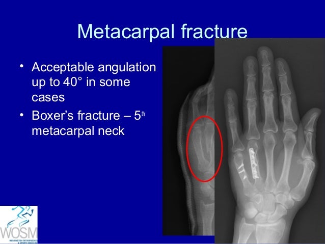 Basics of Hand Surgery